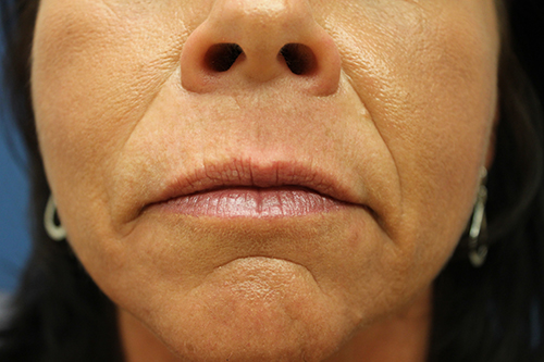 Fractional Laser Skin Resurfacing Case 2 - Cascade Facial Surgery and ...