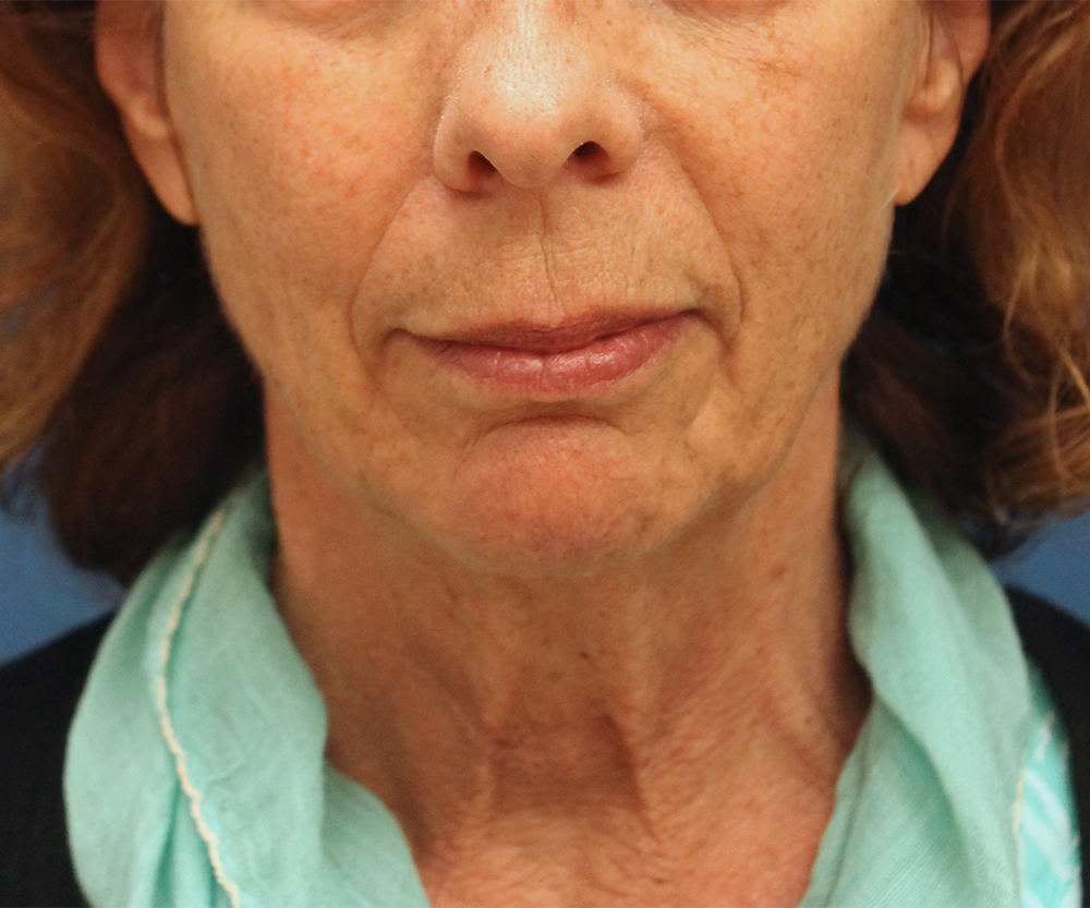 Chin Augmentation Archives - Cascade Facial Surgery and Aesthetics Mt ...