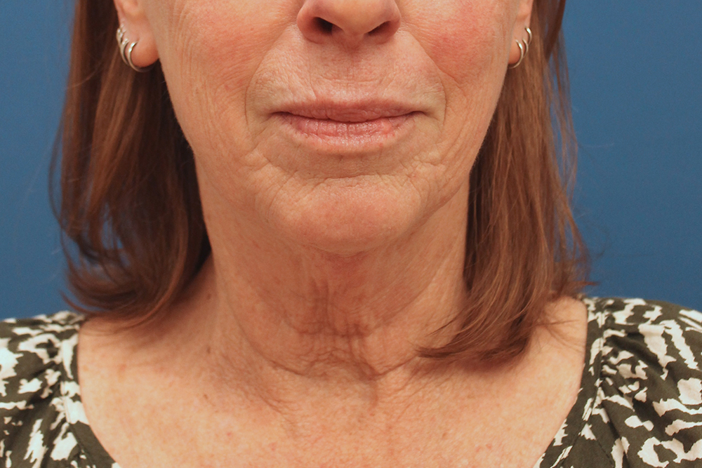 Chin Augmentation Case 4 - Cascade Facial Surgery and Aesthetics Mt. Vernon