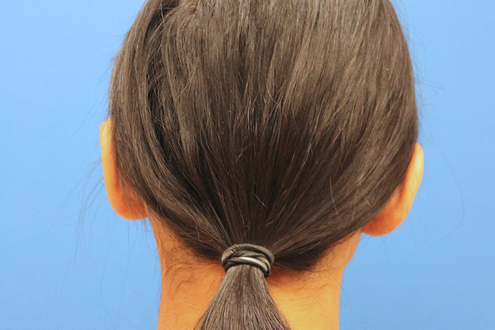 Ear Surgery Archives - Cascade Facial Surgery and Aesthetics Mt. Vernon