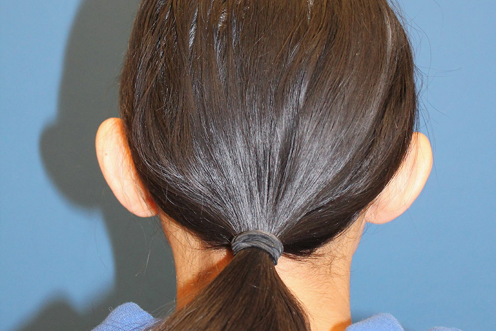 Ear Surgery Archives - Cascade Facial Surgery and Aesthetics Mt. Vernon