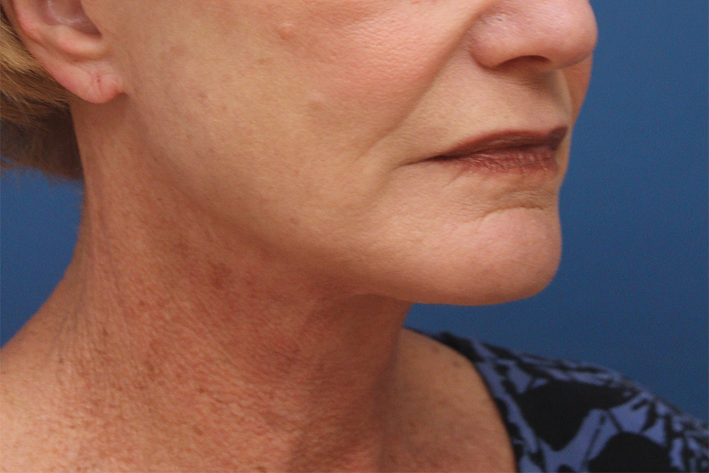 Face and Neck Lift Case 20 - Cascade Facial Surgery and Aesthetics Mt ...