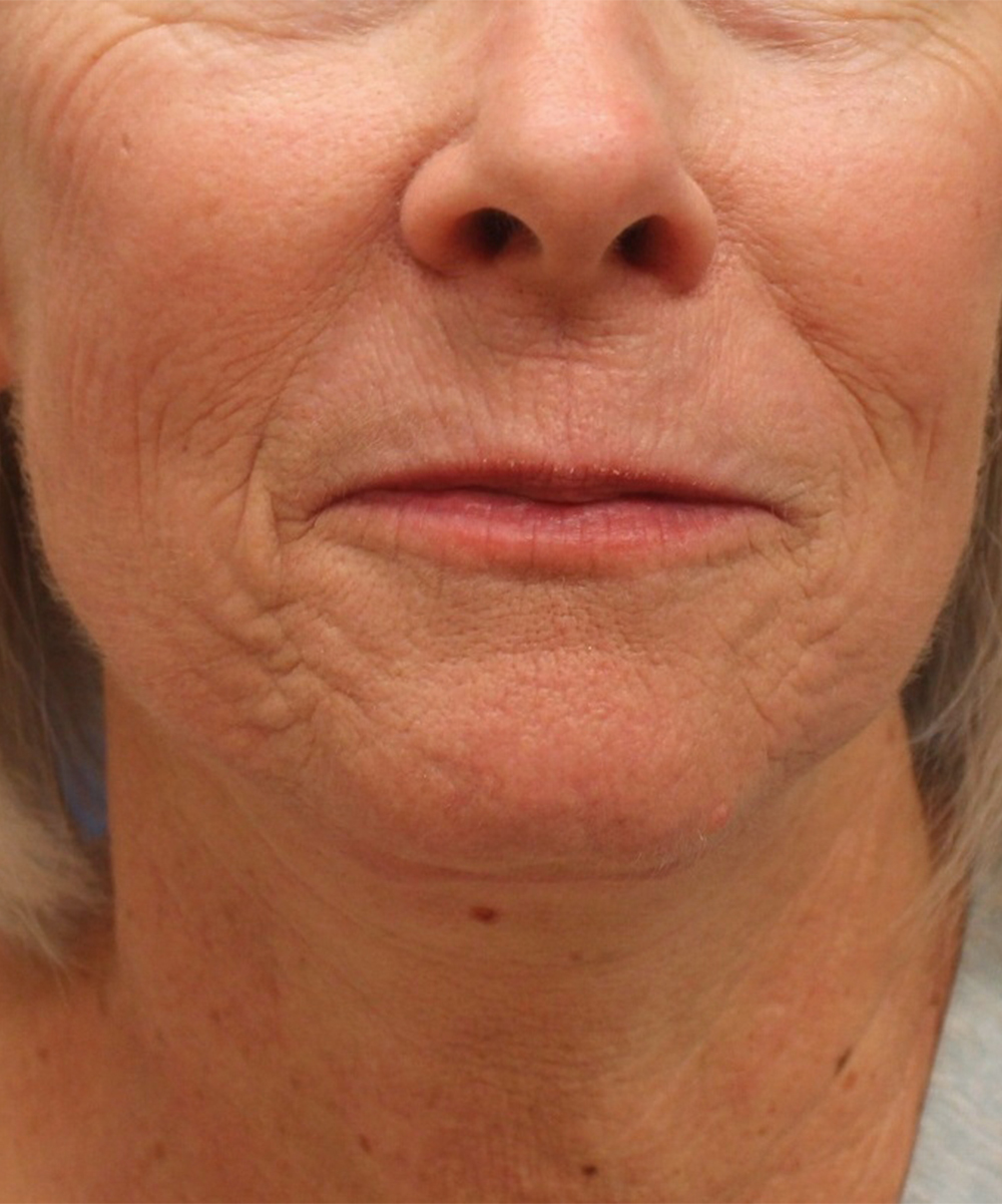 Fractionated C02 Laser Skin Resurfacing Archives