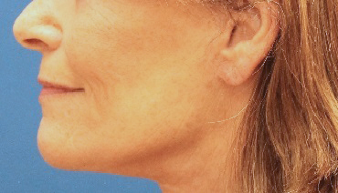 Fractional Laser Skin Resurfacing Case 4 - Cascade Facial Surgery and ...