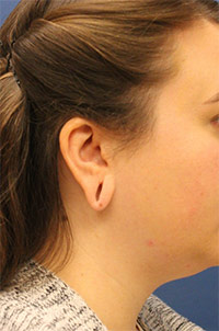 Ear Surgery Archives - Cascade Facial Surgery and Aesthetics Mt. Vernon