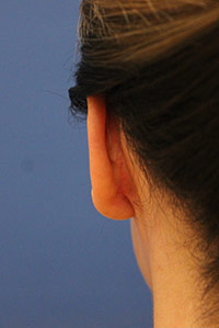 Ear Surgery Archives - Cascade Facial Surgery and Aesthetics Mt. Vernon