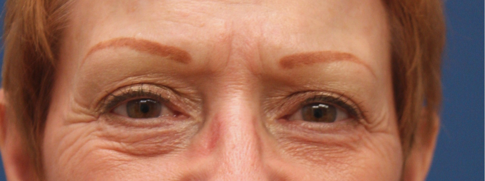 Eyelid Surgery Archives - Cascade Facial Surgery and Aesthetics Mt. Vernon