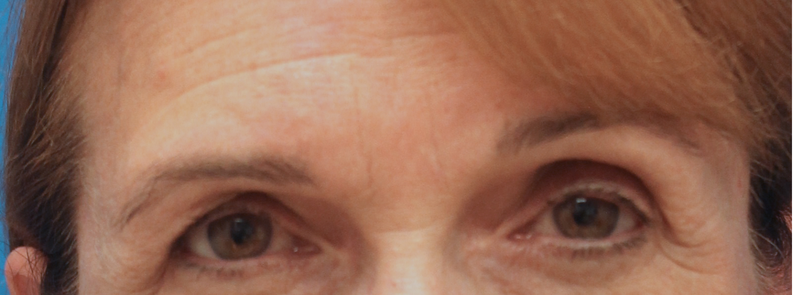 Furrowplasty Archives - Cascade Facial Surgery and Aesthetics Mt. Vernon