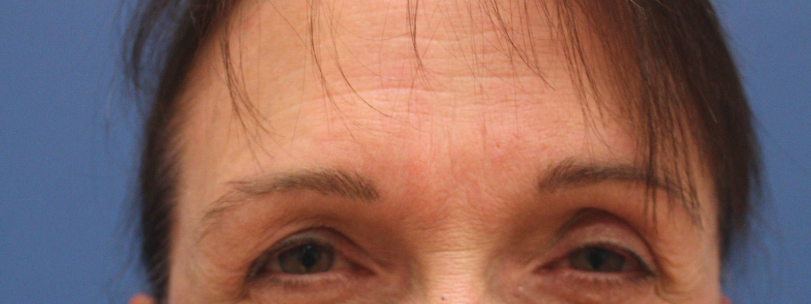 Furrowplasty Archives - Cascade Facial Surgery and Aesthetics Mt. Vernon
