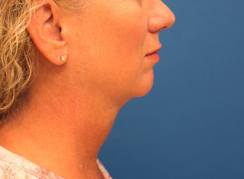 Chin Augmentation Archives - Cascade Facial Surgery and Aesthetics Mt ...