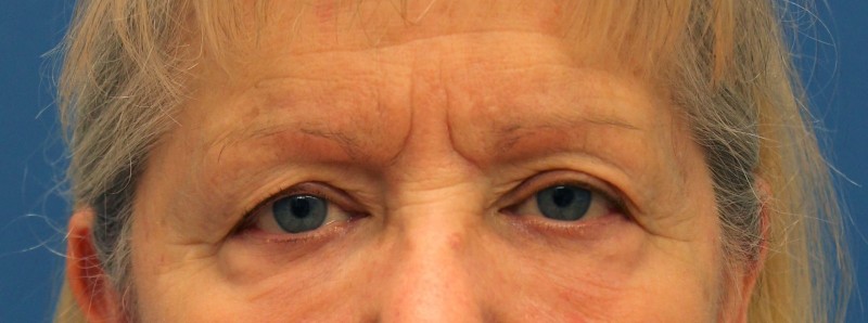 Furrowplasty Archives - Cascade Facial Surgery and Aesthetics Mt. Vernon
