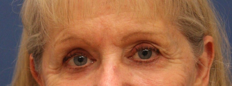 Furrowplasty Archives - Cascade Facial Surgery and Aesthetics Mt. Vernon