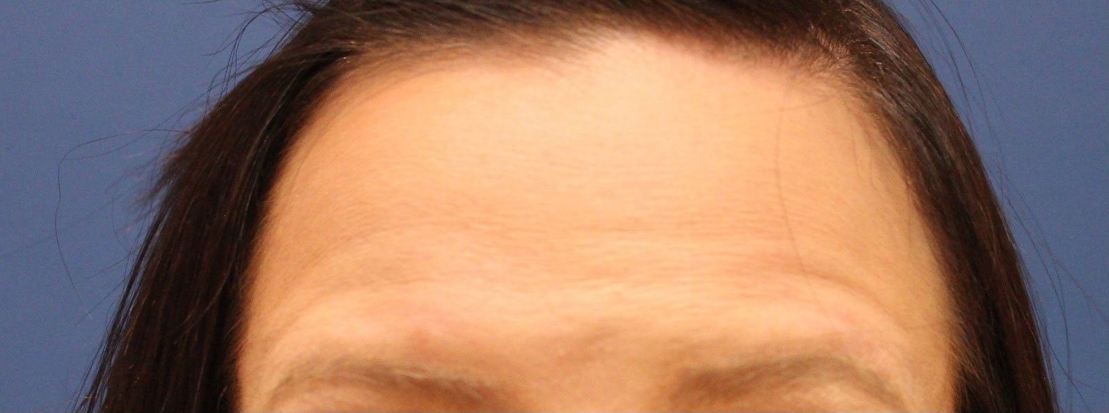 Botox Archives - Cascade Facial Surgery and Aesthetics Mt. Vernon