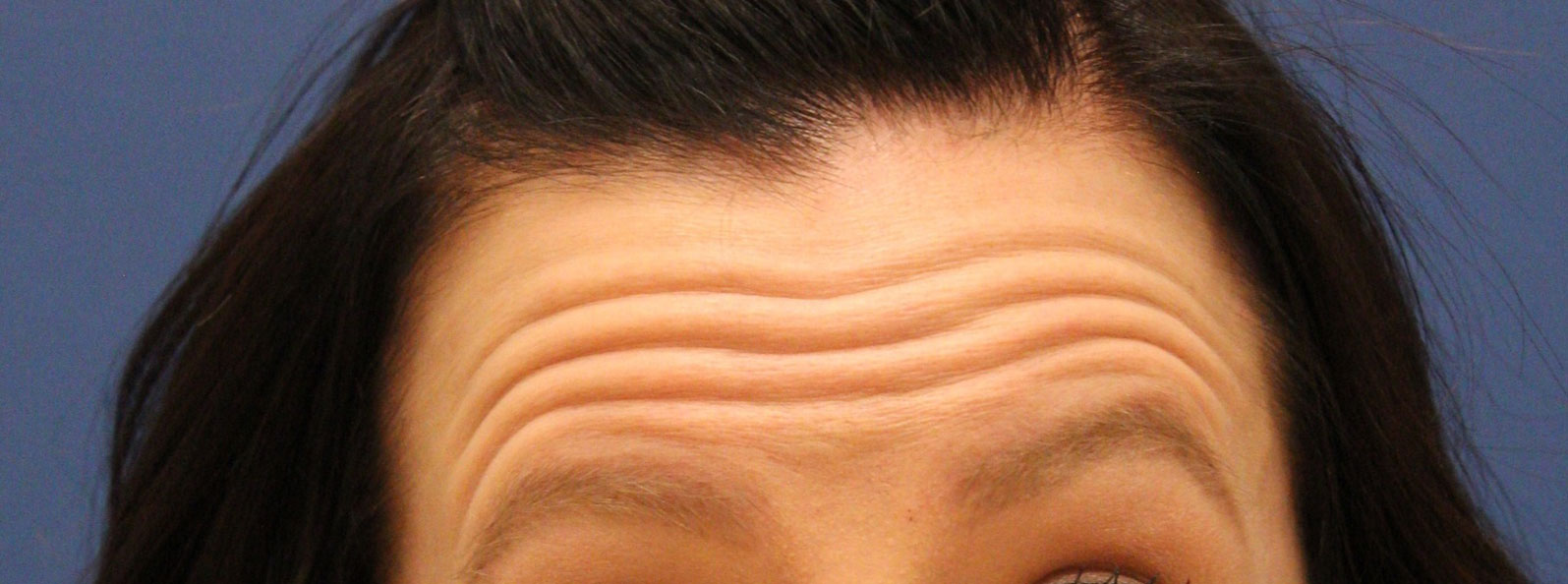 Botox® Case 8 - Cascade Facial Surgery and Aesthetics Mt. Vernon