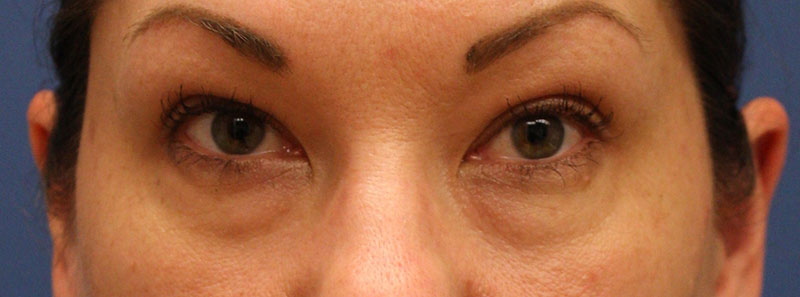 Tear Trough Case 4 - Cascade Facial Surgery and Aesthetics Mt. Vernon