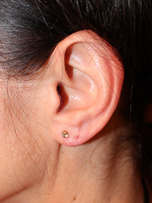 Ear Surgery Archives - Cascade Facial Surgery and Aesthetics Mt. Vernon