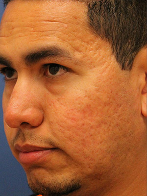 Microneedling Archives - Cascade Facial Surgery and Aesthetics Mt. Vernon