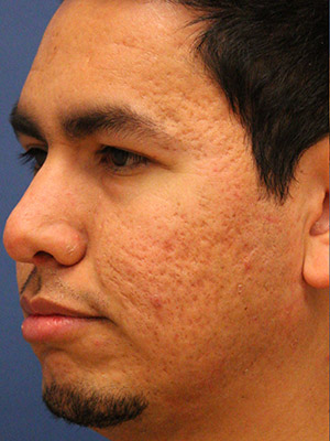 Microneedling Archives - Cascade Facial Surgery and Aesthetics Mt. Vernon