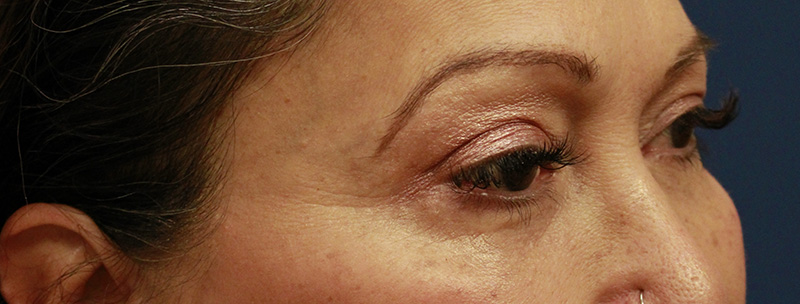 Eyelid Surgery Archives - Cascade Facial Surgery and Aesthetics Mt. Vernon