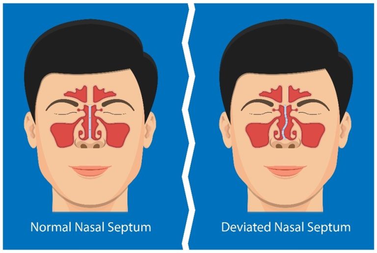 Nasal Surgery Mt Vernon WA - Rhinoplasty Everett WA