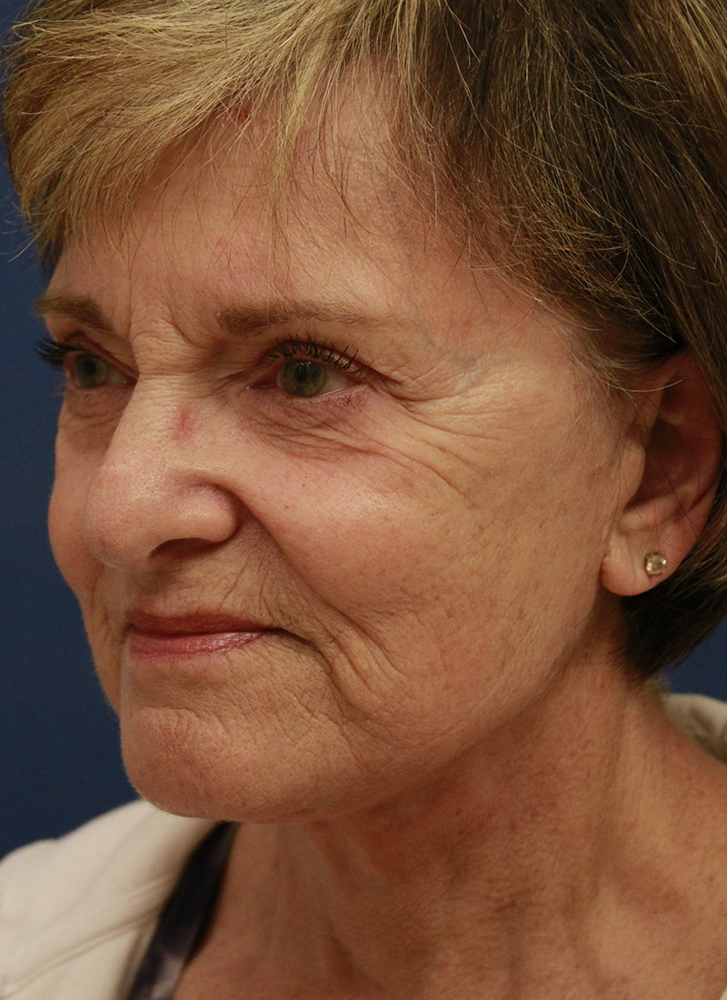 Face and Neck Lift Archives - Cascade Facial Surgery and Aesthetics Mt ...