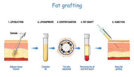 Fat Grafting Mt Vernon - Facial Rejuvenation Everett WA