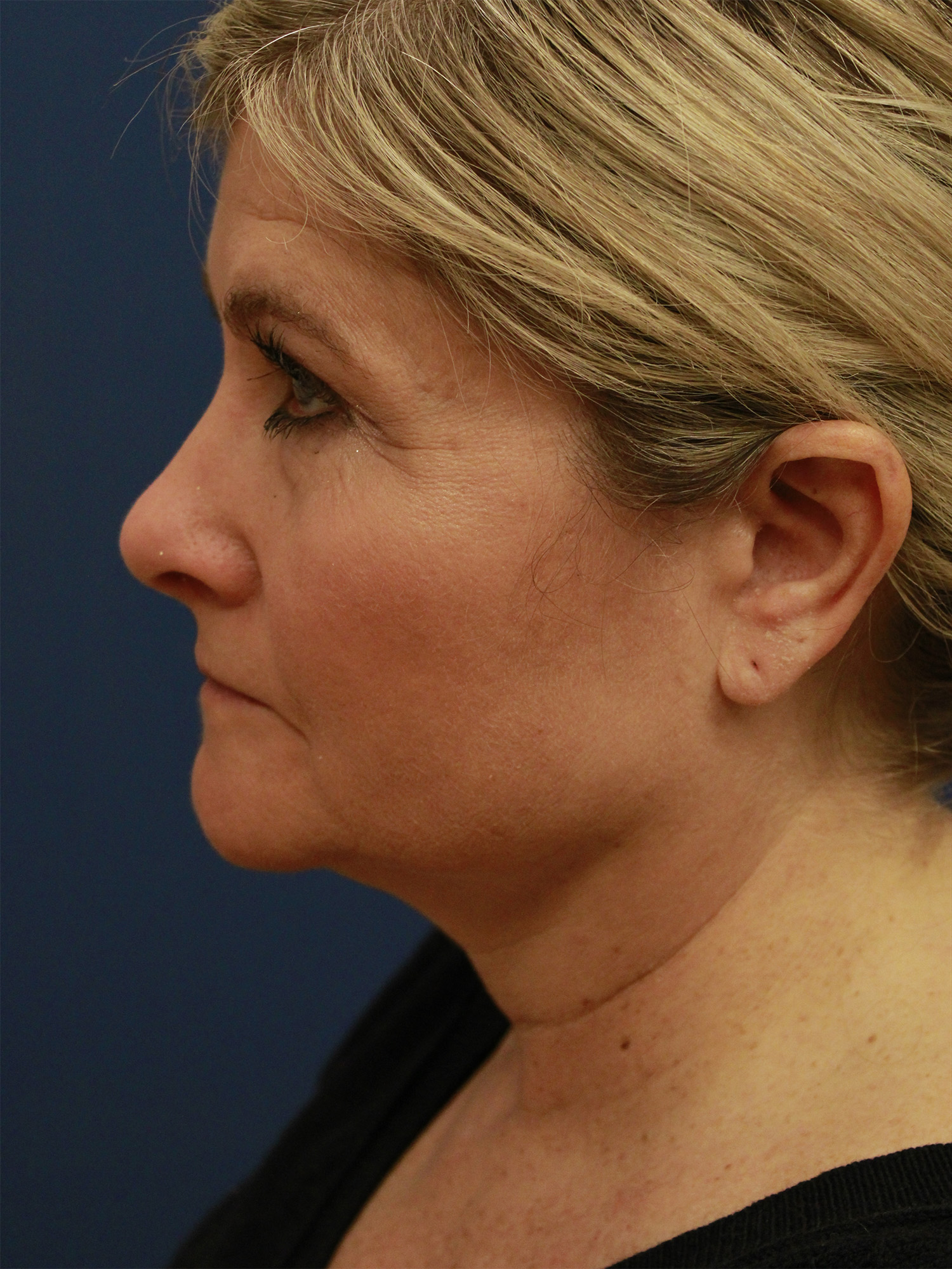 Face and Neck Lift Case 39 - Cascade Facial Surgery and Aesthetics Mt ...