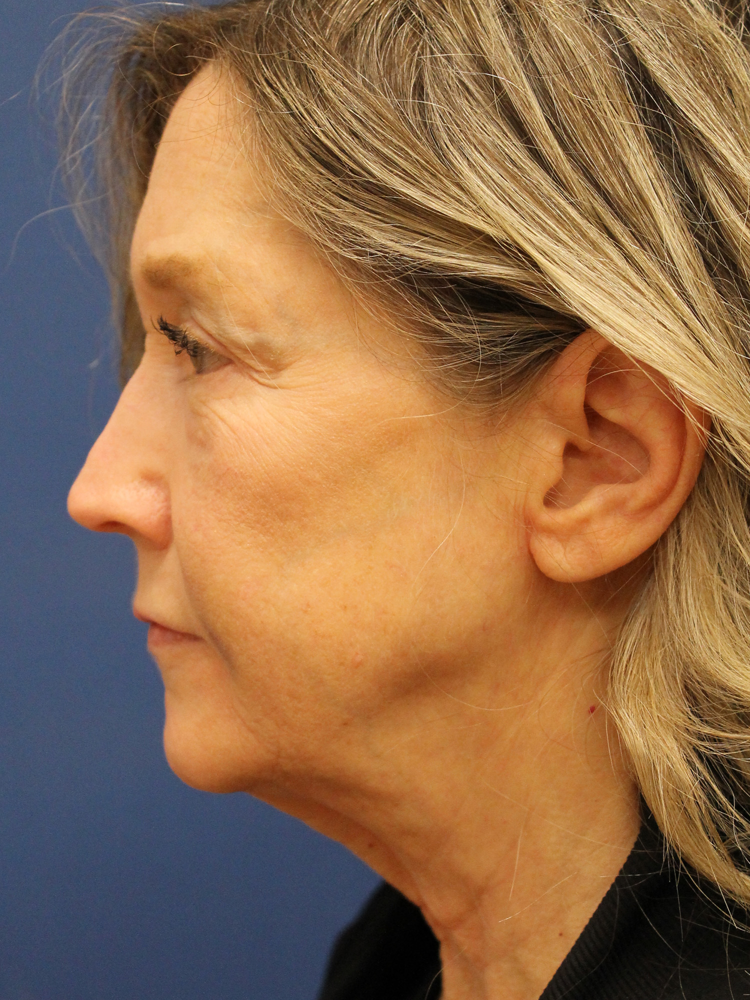 Face and Neck Lift Case 40 - Cascade Facial Surgery and Aesthetics Mt ...