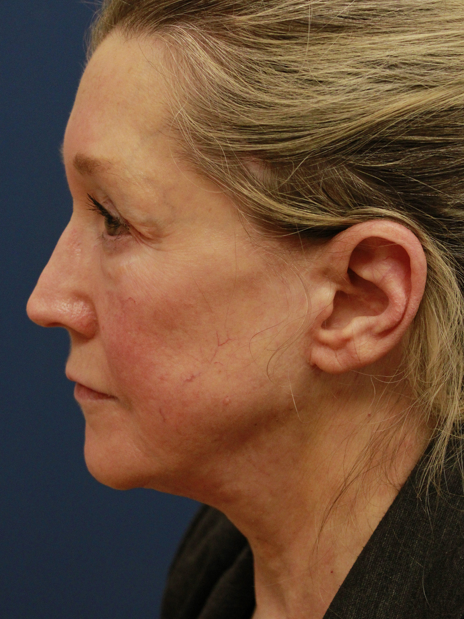 Face and Neck Lift Case 40 - Cascade Facial Surgery and Aesthetics Mt ...
