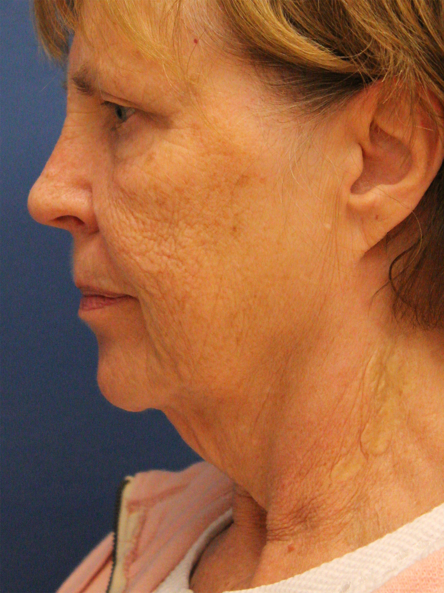 Face and Neck Lift Case 41 - Cascade Facial Surgery and Aesthetics Mt ...