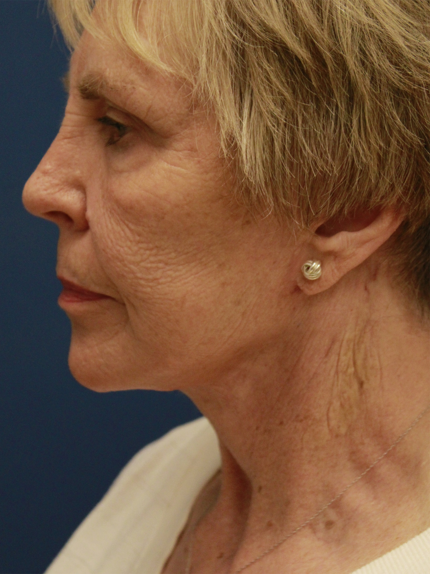 Face and Neck Lift Case 41 - Cascade Facial Surgery and Aesthetics Mt ...