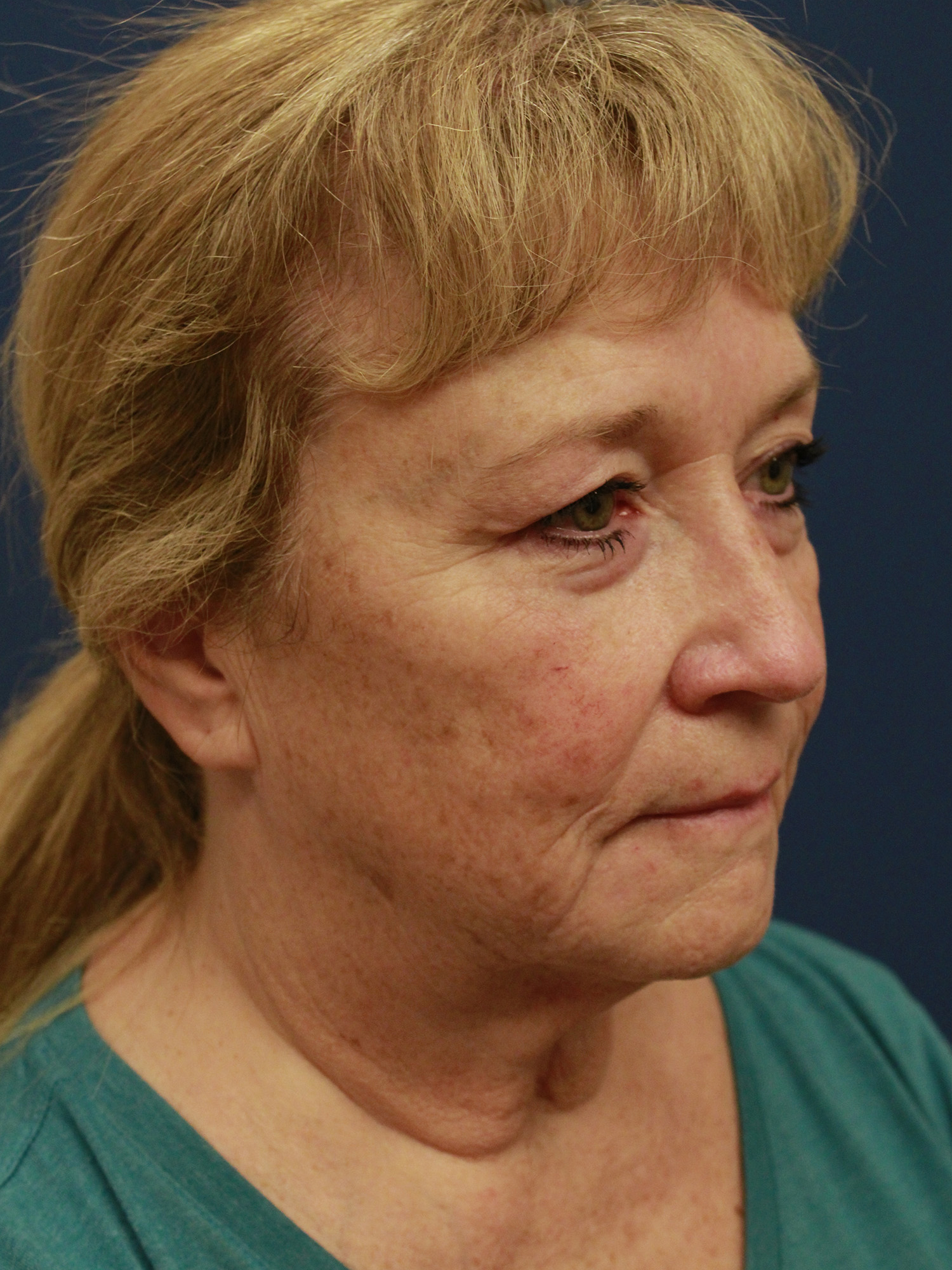 Face and Neck Lift Case 44 - Cascade Facial Surgery and Aesthetics Mt ...