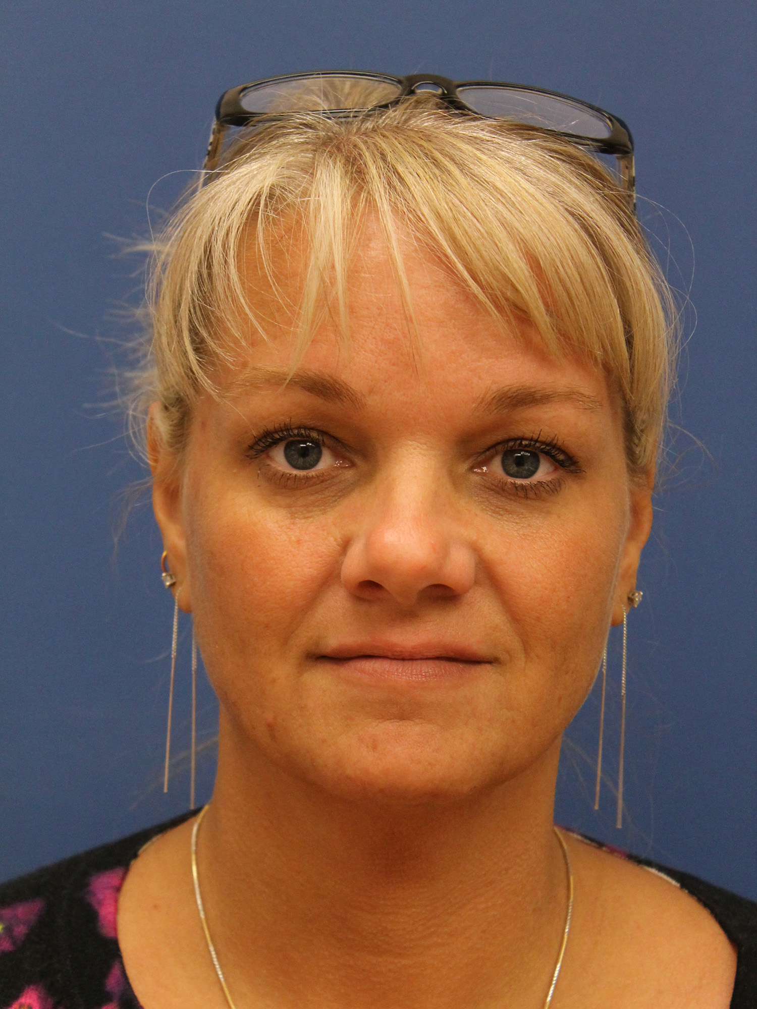 Face and Neck Lift Case 45 - Cascade Facial Surgery and Aesthetics Mt ...