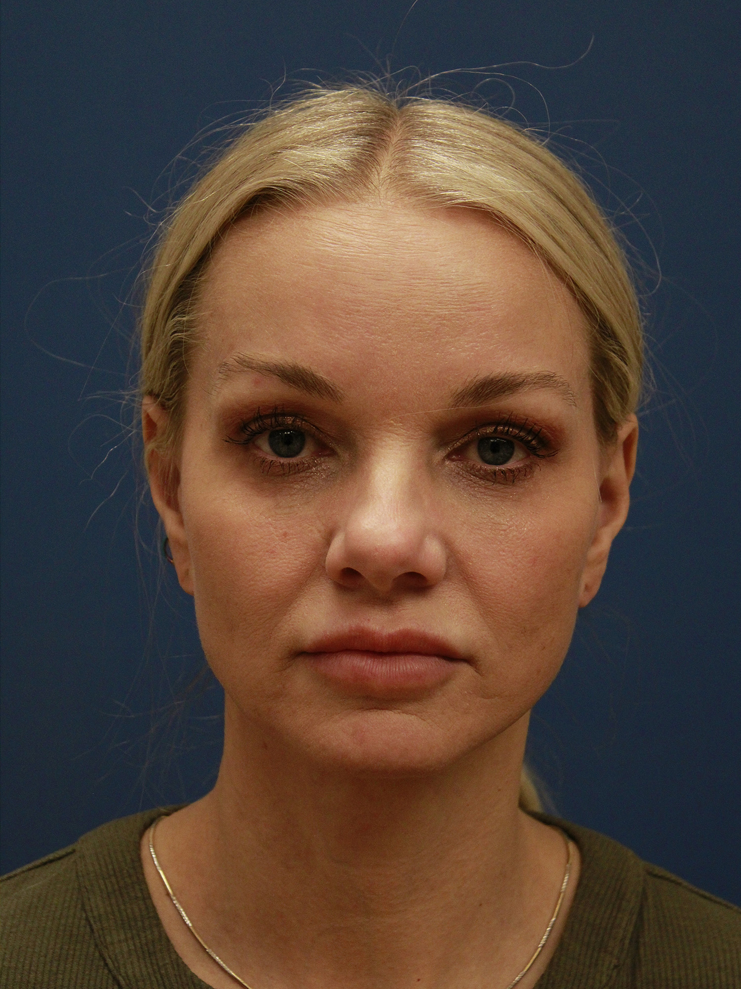 Face and Neck Lift Case 45 - Cascade Facial Surgery and Aesthetics Mt ...