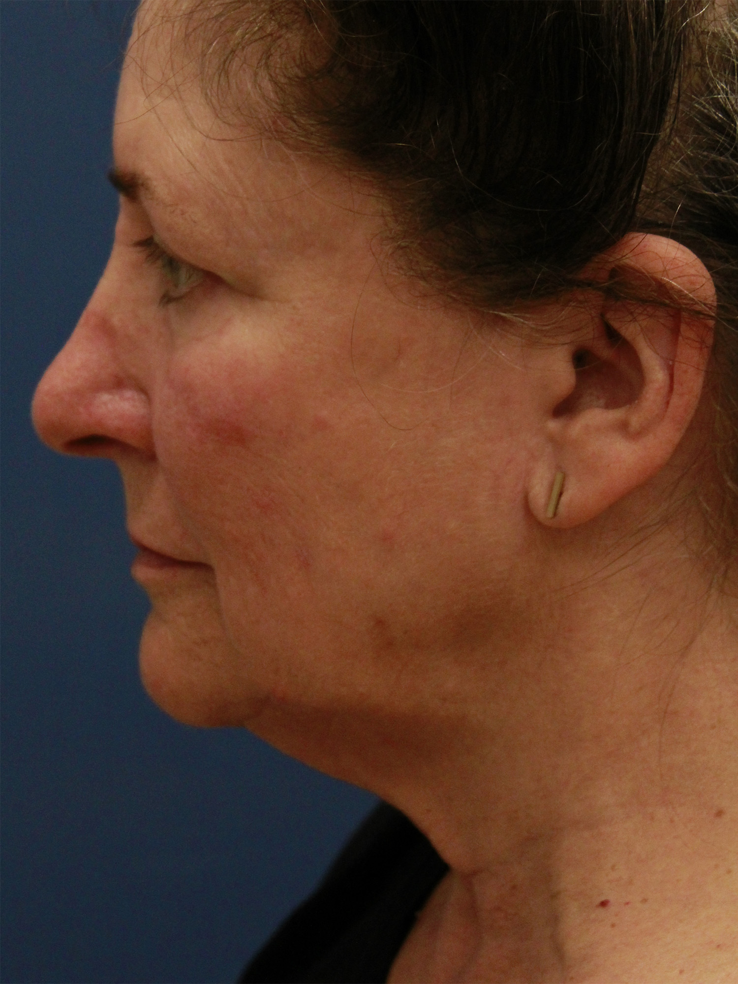 Face and Neck Lift Case 47 - Cascade Facial Surgery and Aesthetics Mt ...