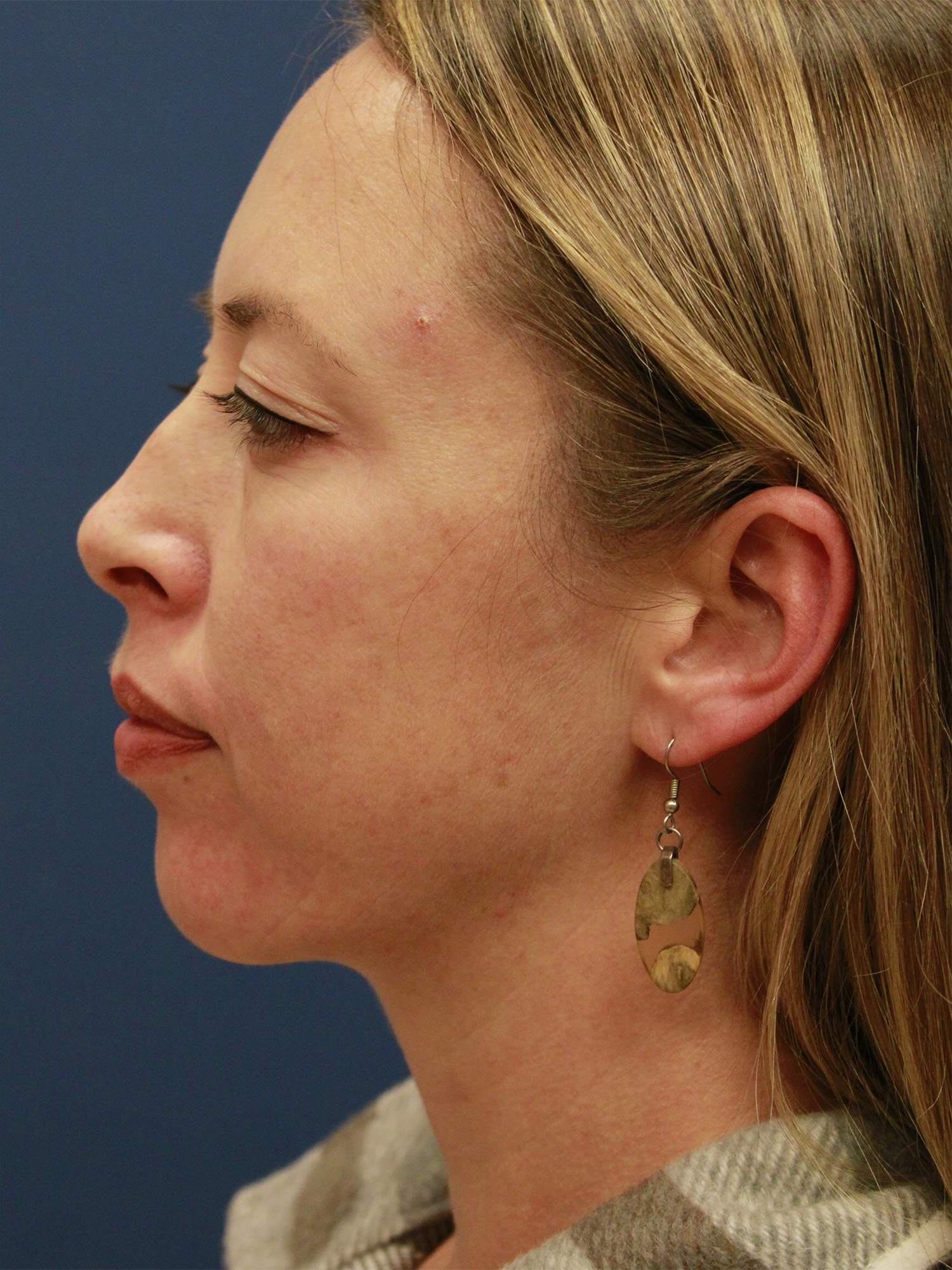 Chin Augmentation Case 9 - Cascade Facial Surgery and Aesthetics Mt. Vernon